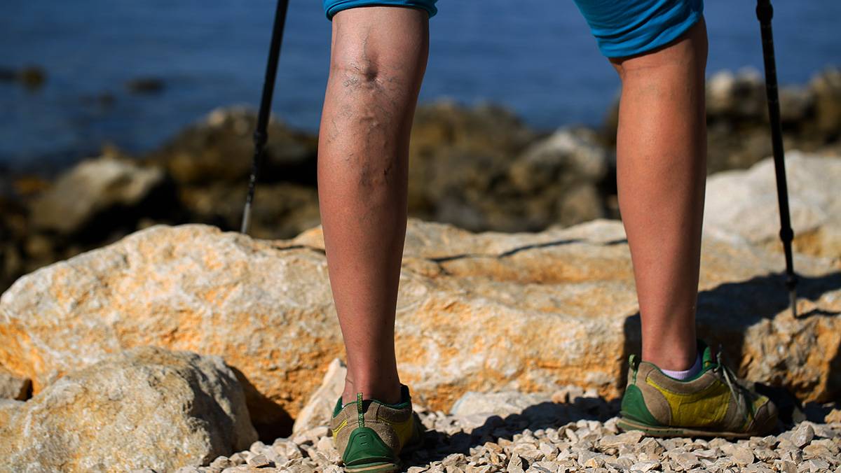 A magyar visszér a legszebb a világon | 24.hu