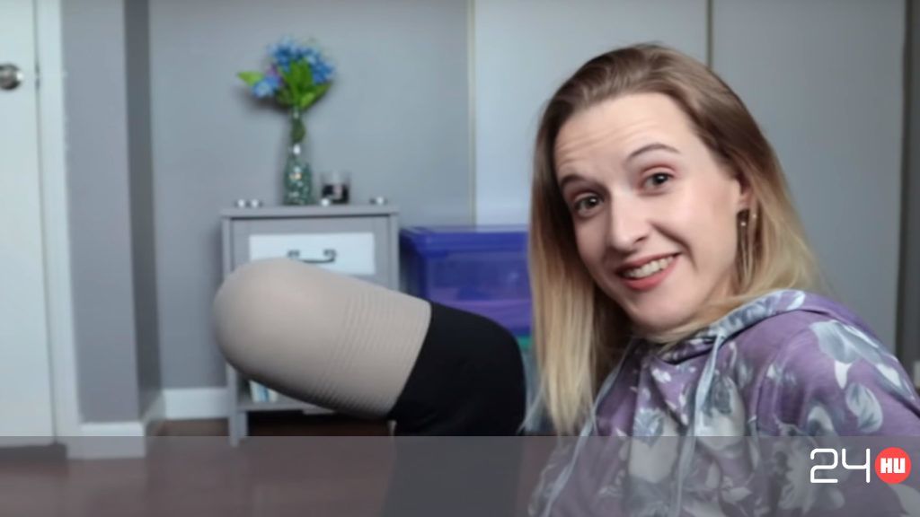 Önként amputáltatta jobb lábát egy fiatal amerikai nő | 24.hu