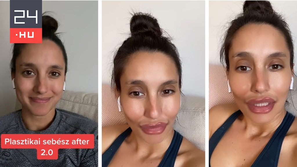 Trokán Nóra megmutatta, hogy nézne ki ma divatos arcplasztikák után | 24.hu