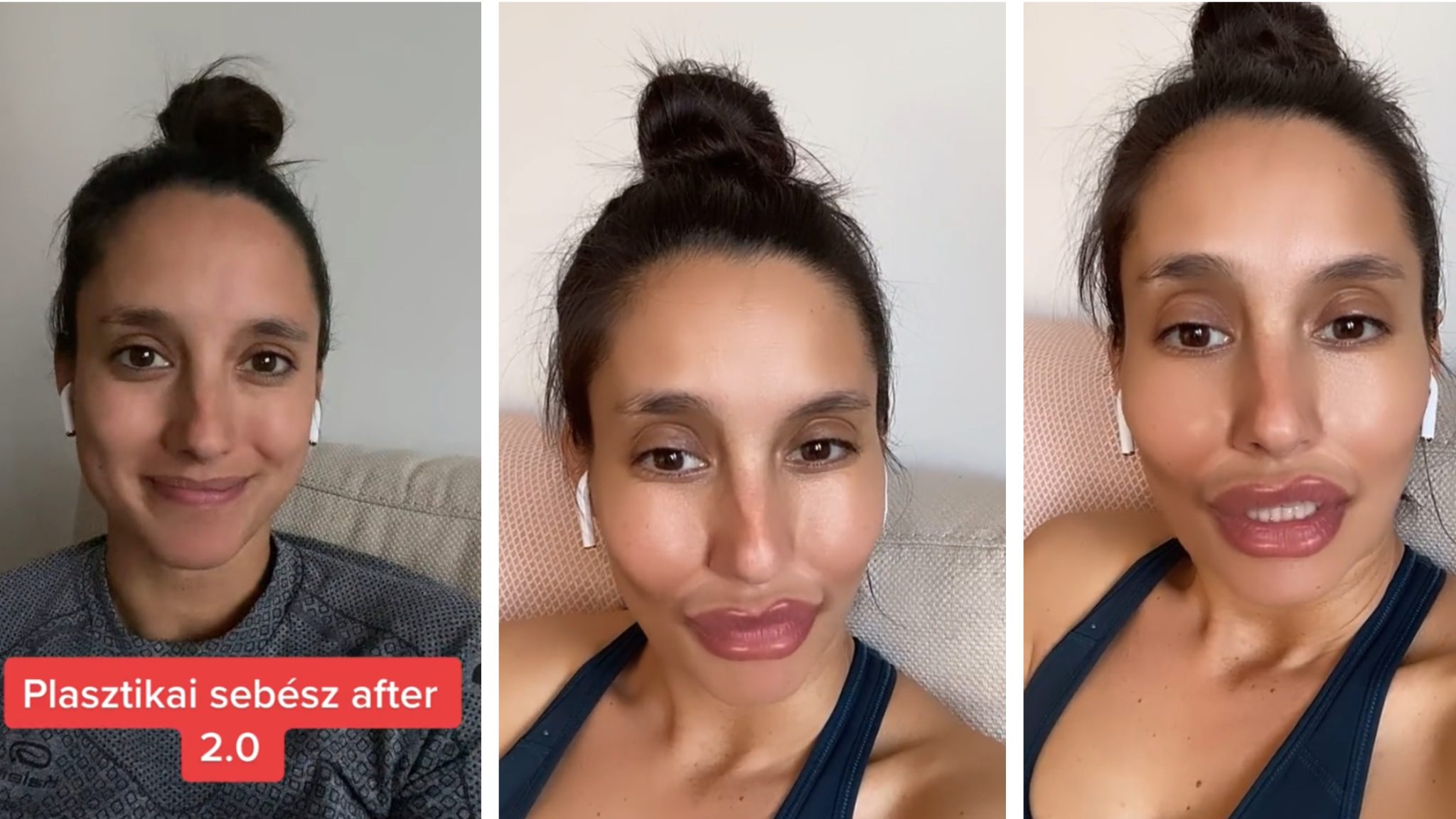 Trokán Nóra megmutatta, hogy nézne ki ma divatos arcplasztikák után | 24.hu