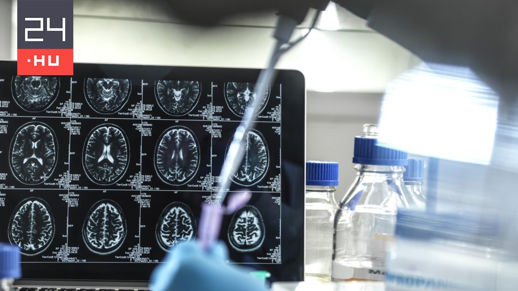 Ritka esetekben átadható lehet az Alzheimer-kór | 24.hu