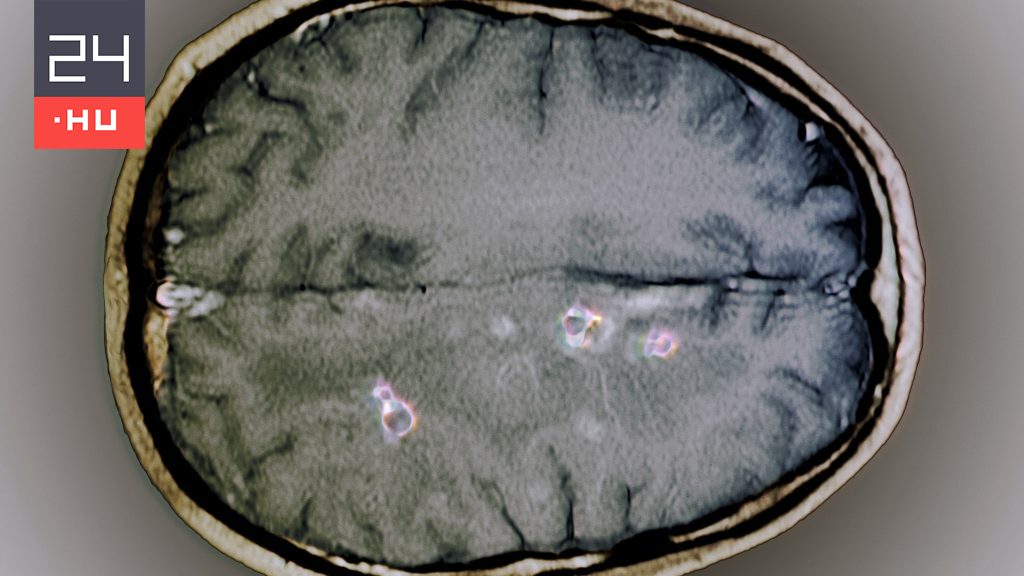 Férgek fészkeltek egy amerikai férfi agyába | 24.hu
